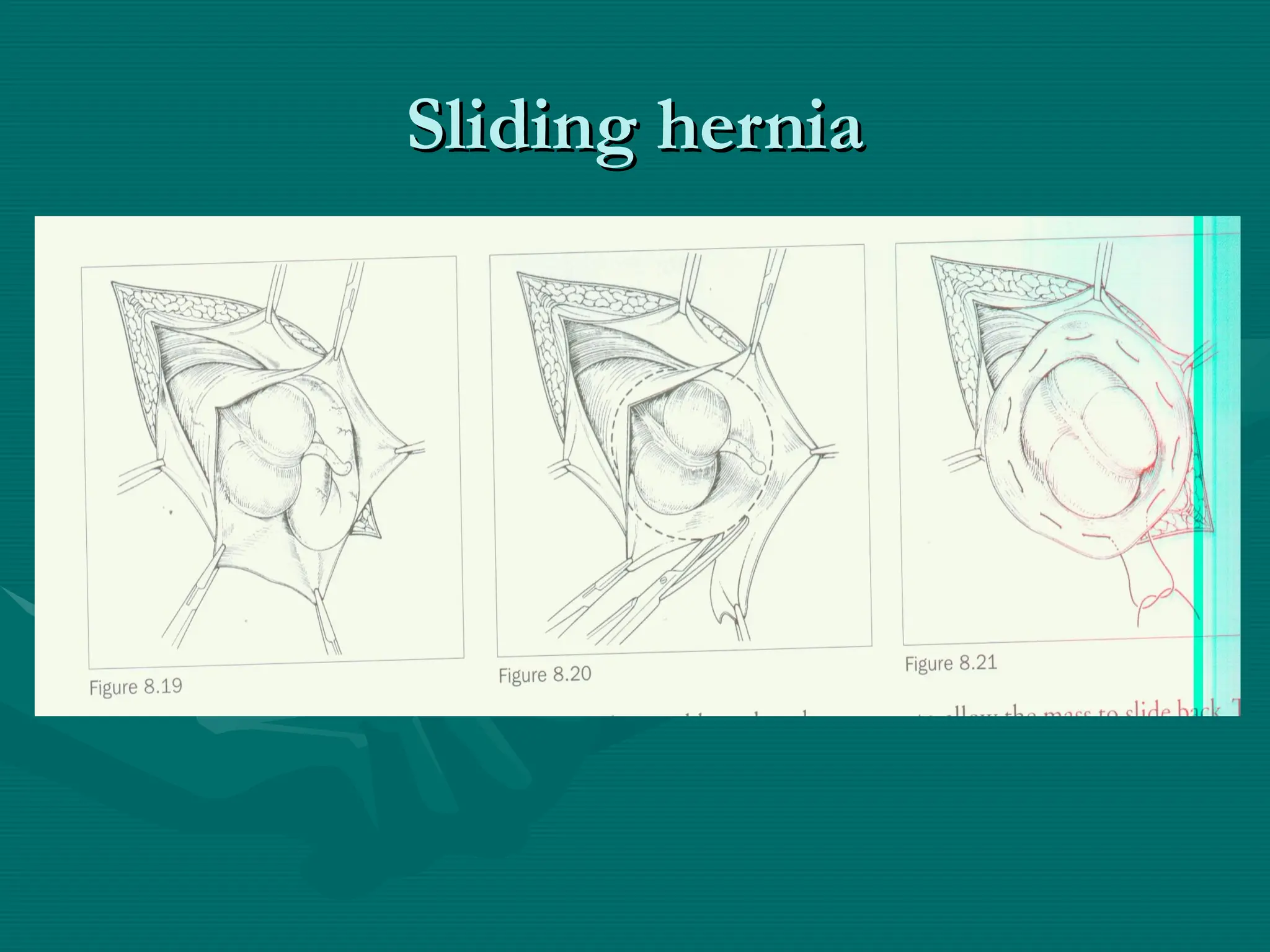 Abdominal wall hernia git system definition | PPT