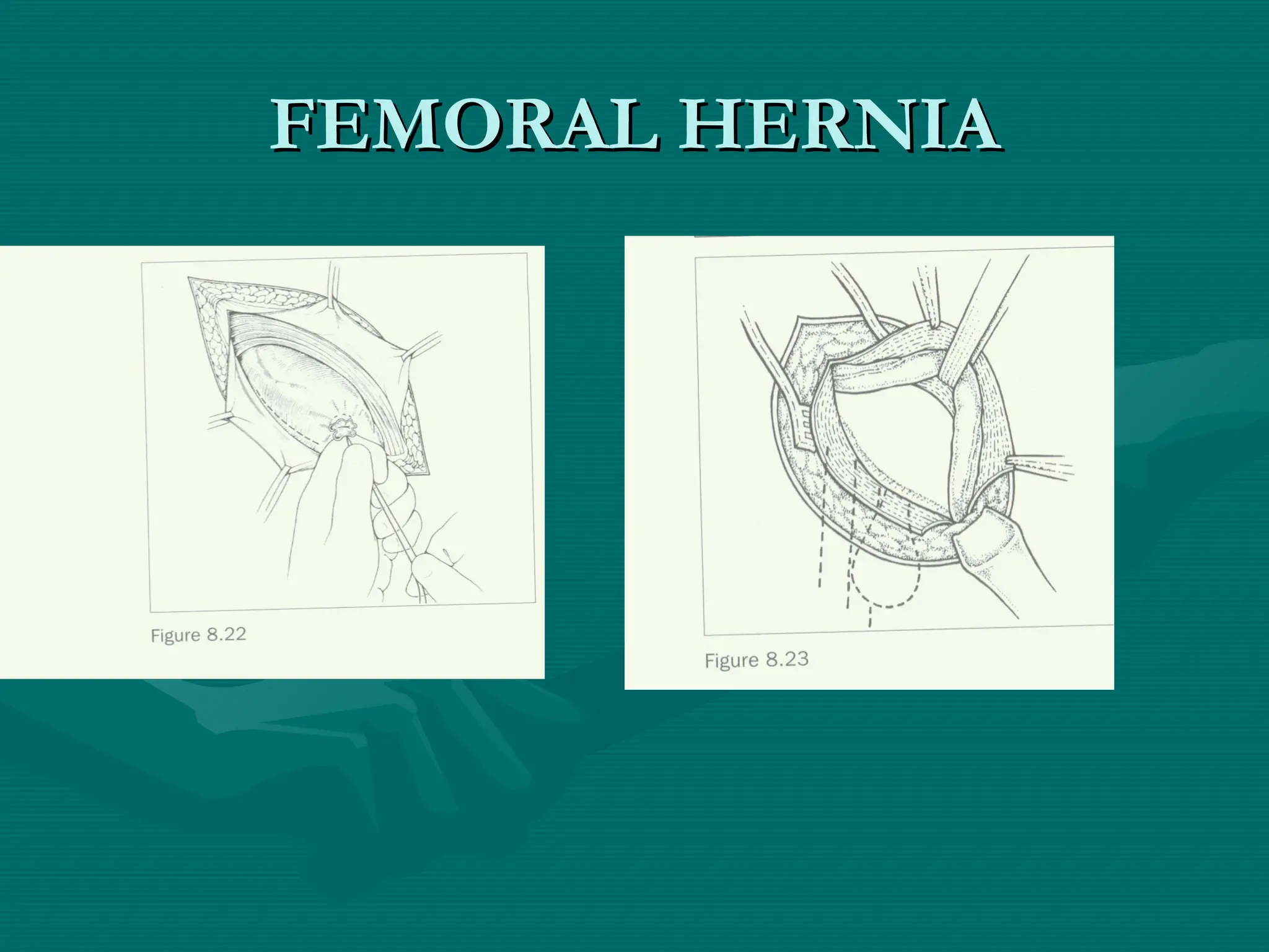 Abdominal wall hernia git system definition | PPT