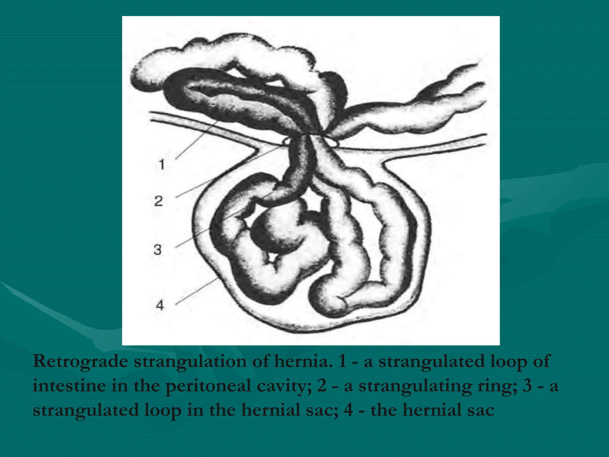 Abdominal wall hernia git system definition | PPT