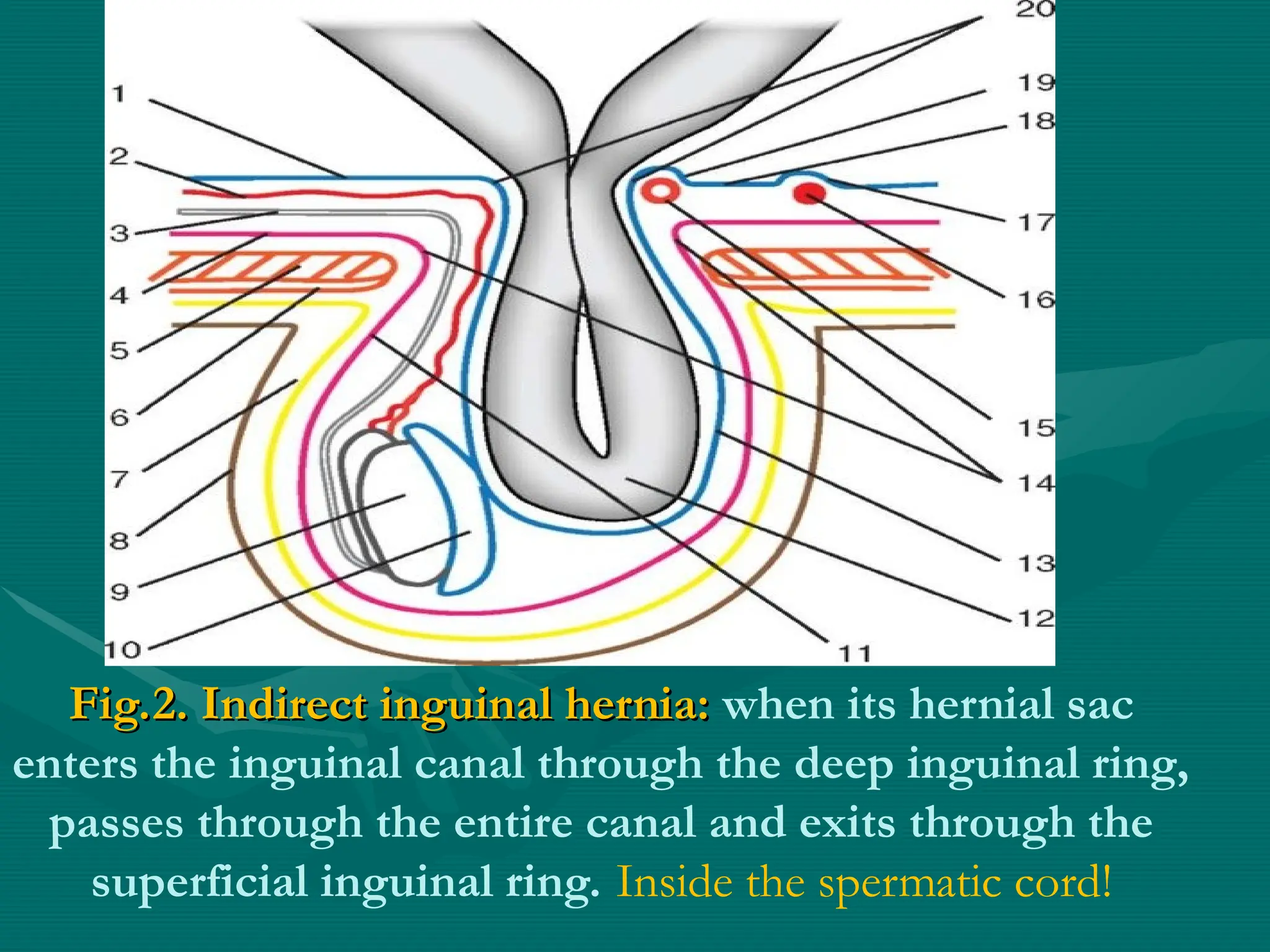 Abdominal wall hernia git system definition | PPT