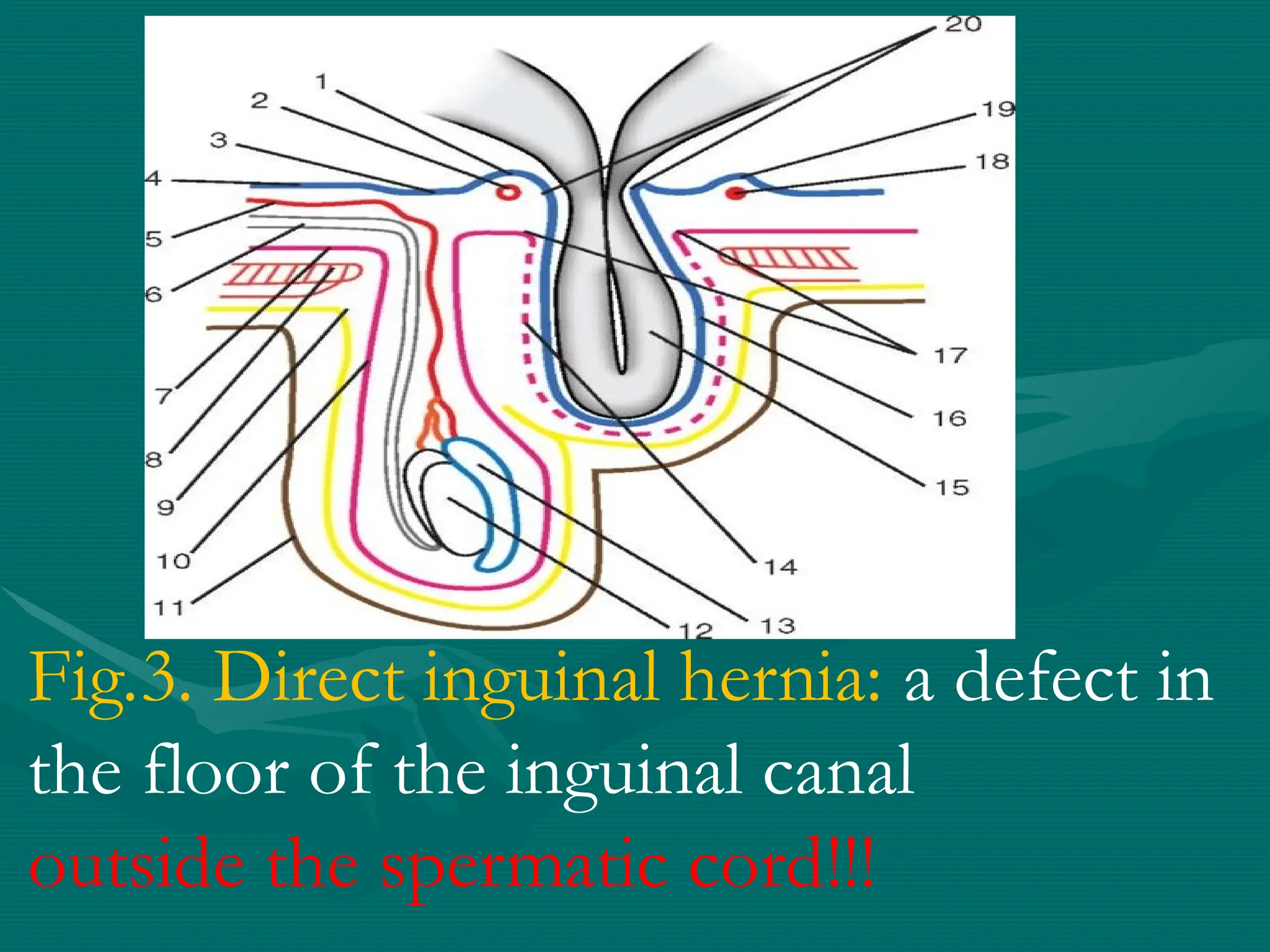 Abdominal wall hernia git system definition | PPT