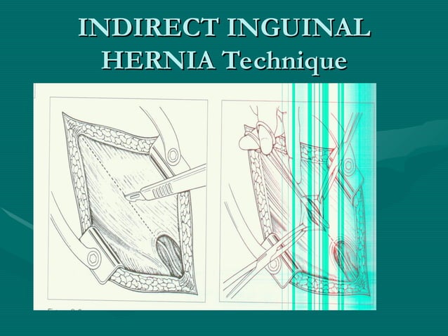 Abdominal wall hernia git system definition | PPT