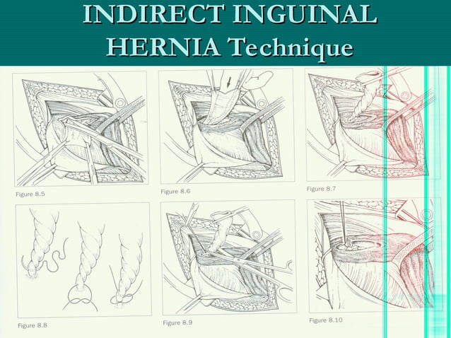 Abdominal wall hernia git system definition | PPT