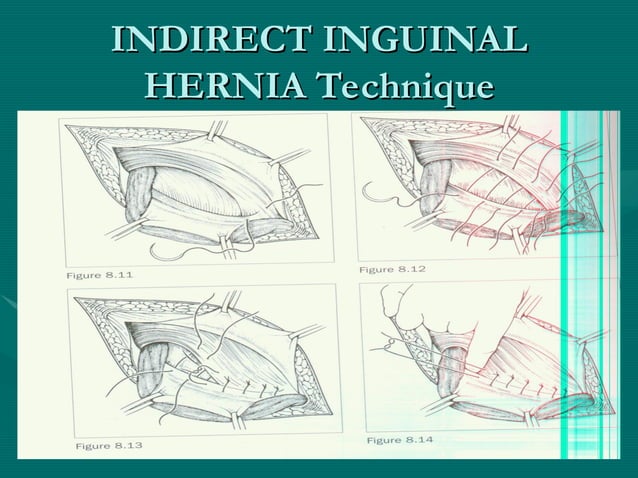 Abdominal wall hernia git system definition | PPT