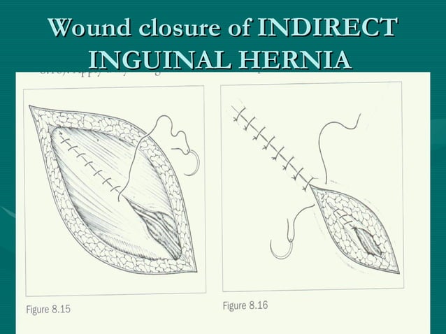 Abdominal wall hernia git system definition | PPT