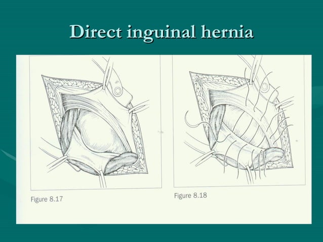 Abdominal wall hernia git system definition | PPT