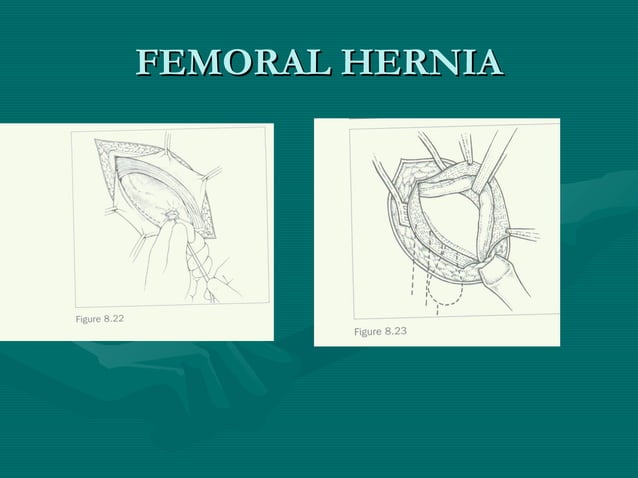 Abdominal wall hernia git system definition | PPT