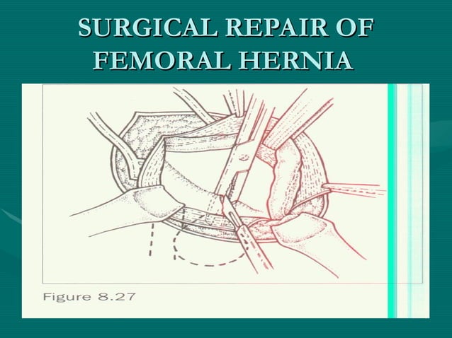 Abdominal wall hernia git system definition | PPT