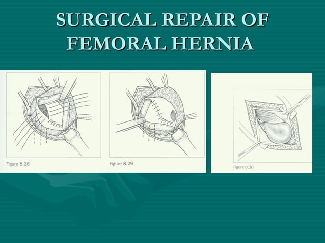 Abdominal wall hernia git system definition | PPT