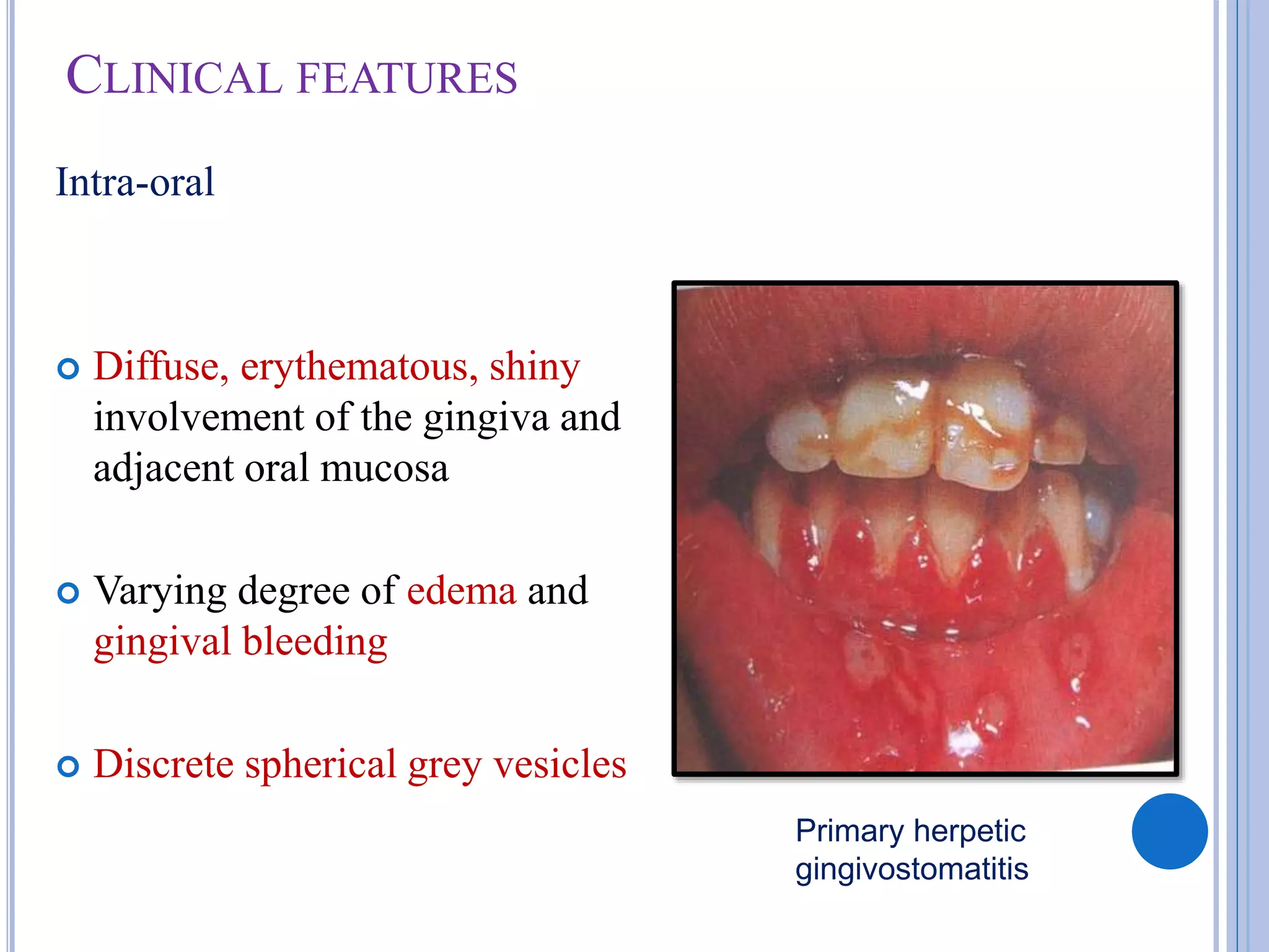 acute gingival infections | PPTX