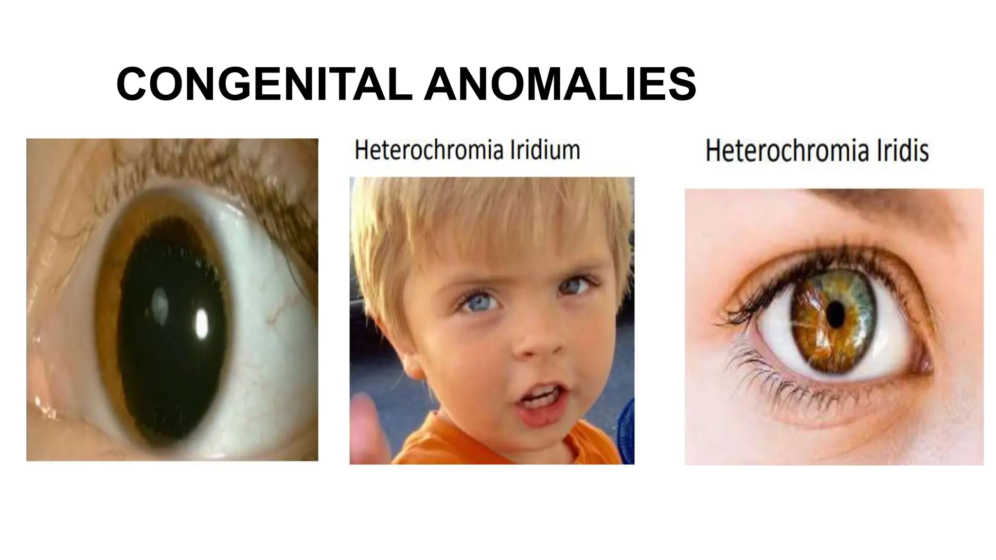Anatomy of uvea UVEA of ophthalmology.pptx