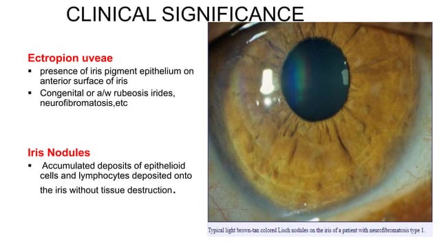 Anatomy of uvea UVEA of ophthalmology.pptx