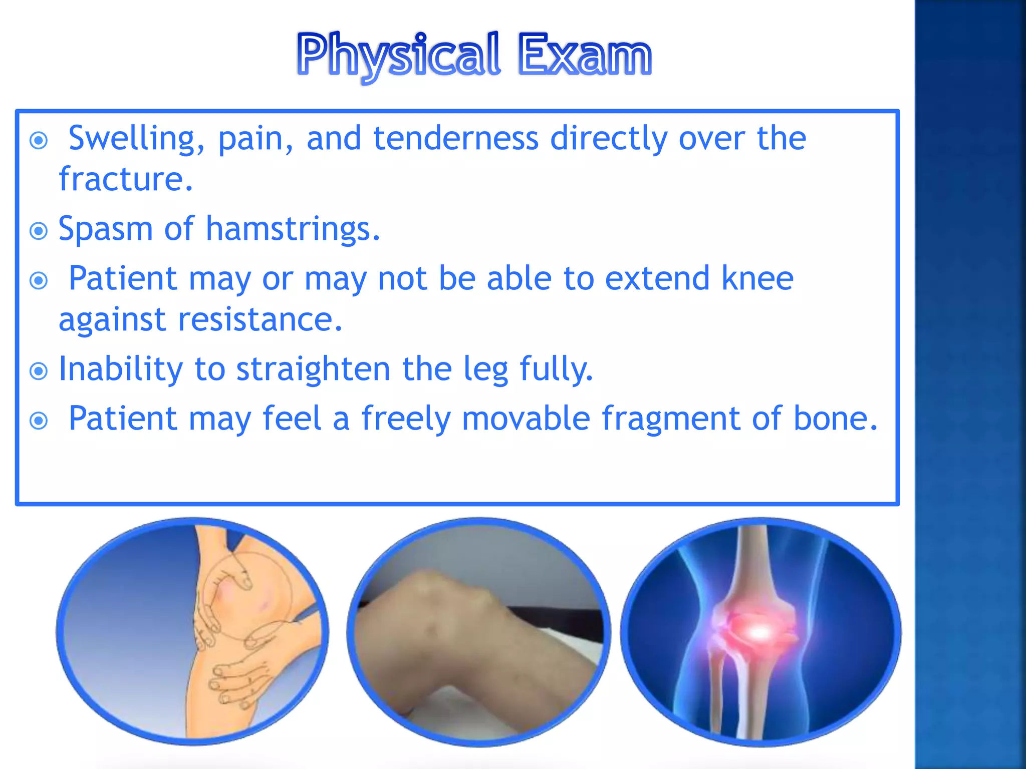 Tibial Tubercle Avulsion Fracture Powerpoint (1) | PPTX