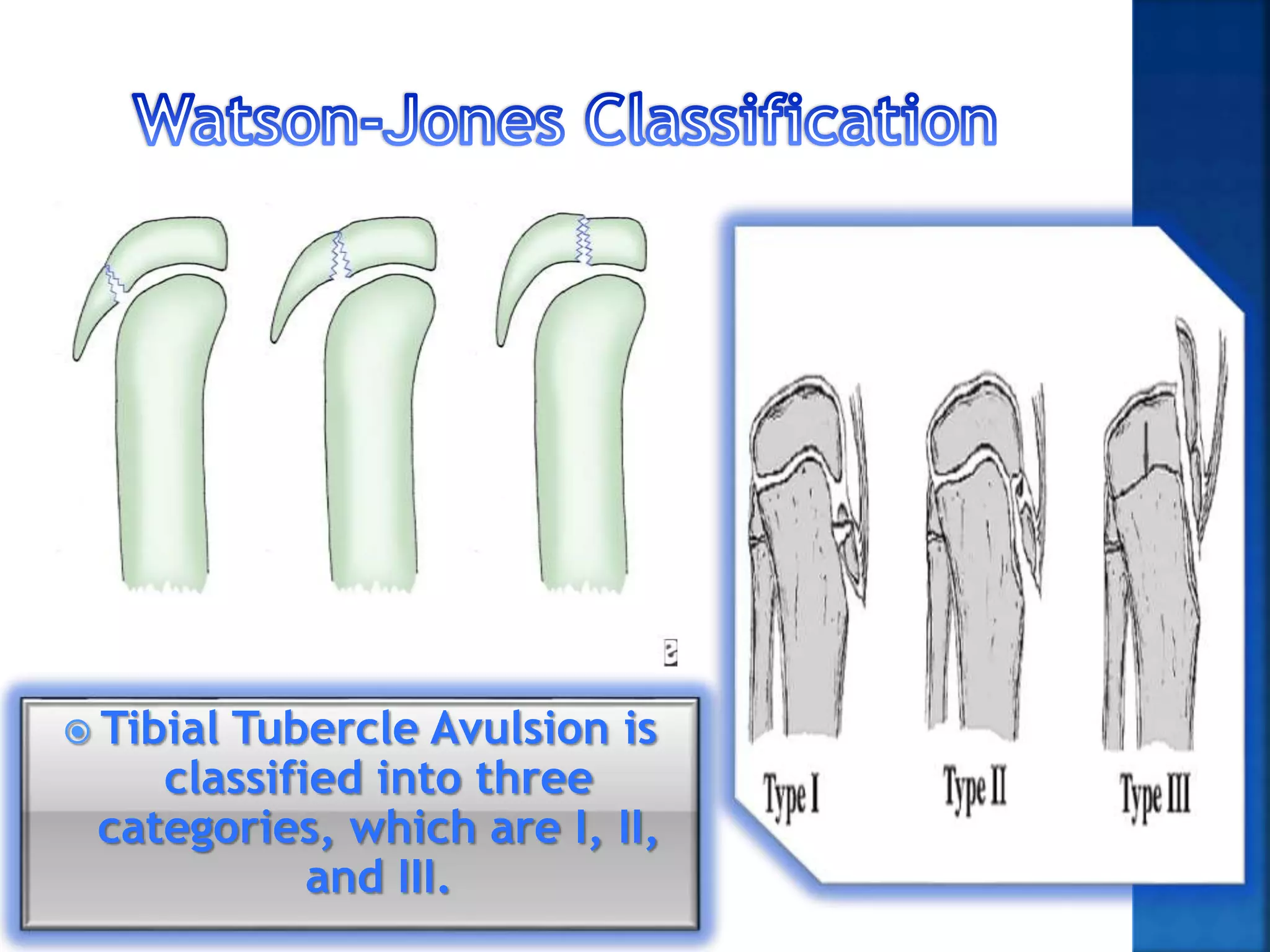 Tibial Tubercle Avulsion Fracture Powerpoint (1) | PPTX