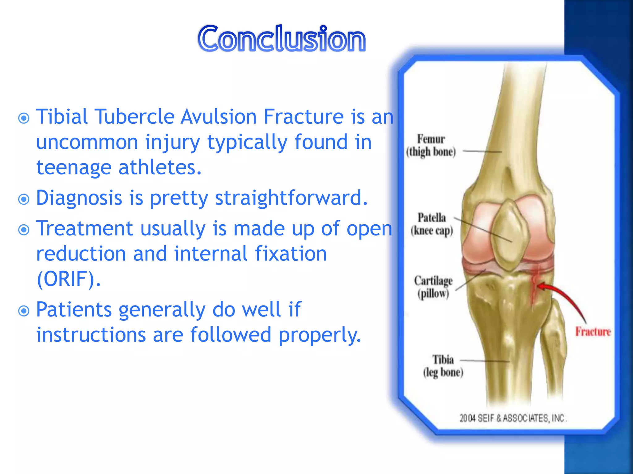Tibial Tubercle Avulsion Fracture Powerpoint (1) | PPTX