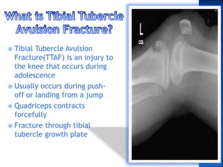 Tibial Tubercle Avulsion Fracture Powerpoint (1) | PPTX