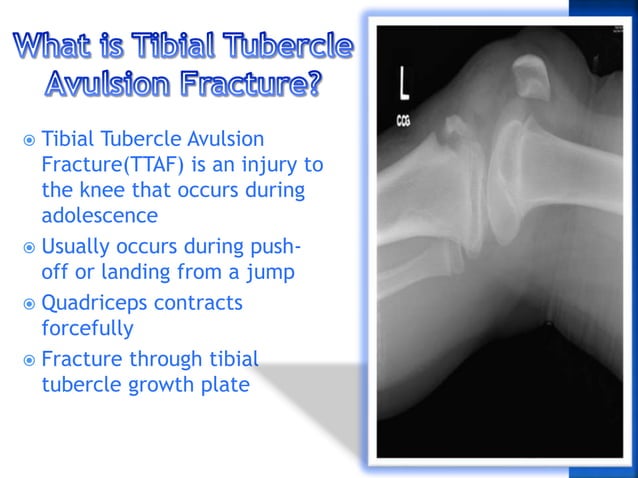 Tibial Tubercle Avulsion Fracture Powerpoint 1 Ppt