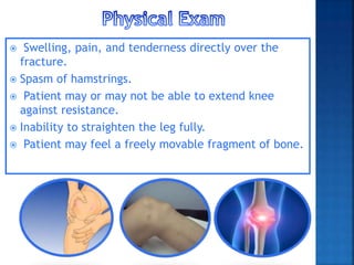 Tibial Tubercle Avulsion Fracture Powerpoint (1) | PPTX