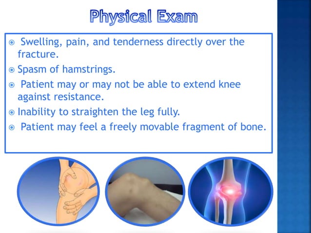 Tibial Tubercle Avulsion Fracture Powerpoint (1) | PPTX