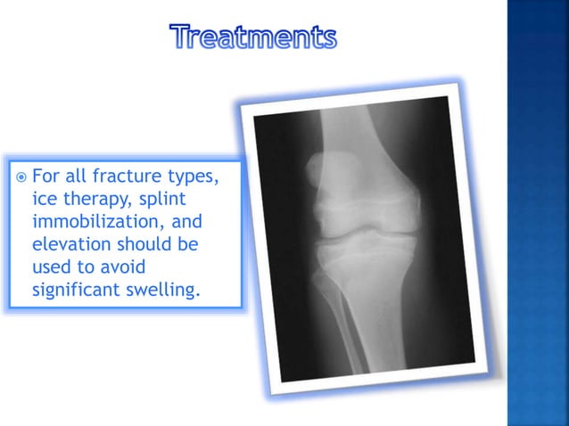 Tibial Tubercle Avulsion Fracture Powerpoint (1) | PPTX