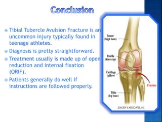 Tibial Tubercle Avulsion Fracture Powerpoint (1) | PPTX
