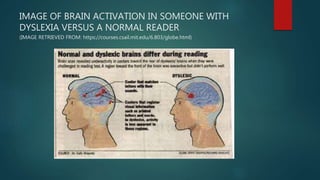 DYSLEXIA | PPTX