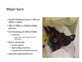 9 burn | PPTX | First Aid | Injuries