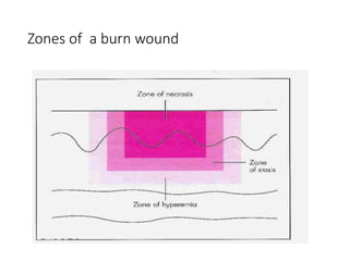 9 burn | PPTX
