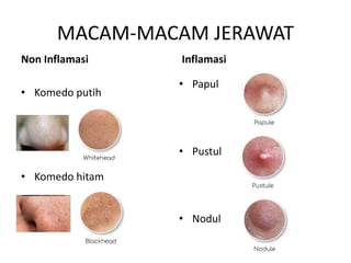 9C. PPT JERAWAT.pptx