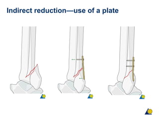 Surgical reduction techniques | PPT