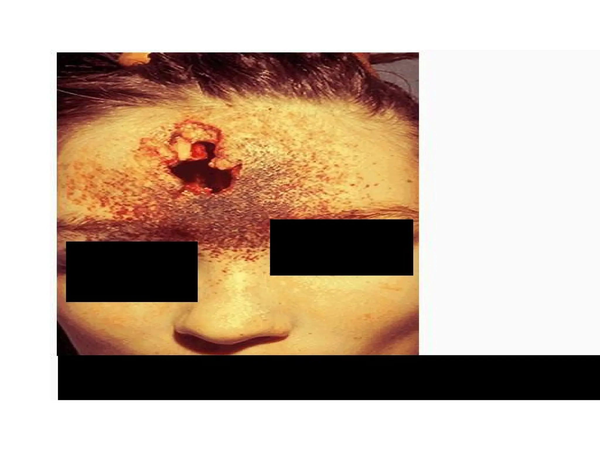 9CHARACTERS OF FIRE ARM INJURIES (WOUND).ppt