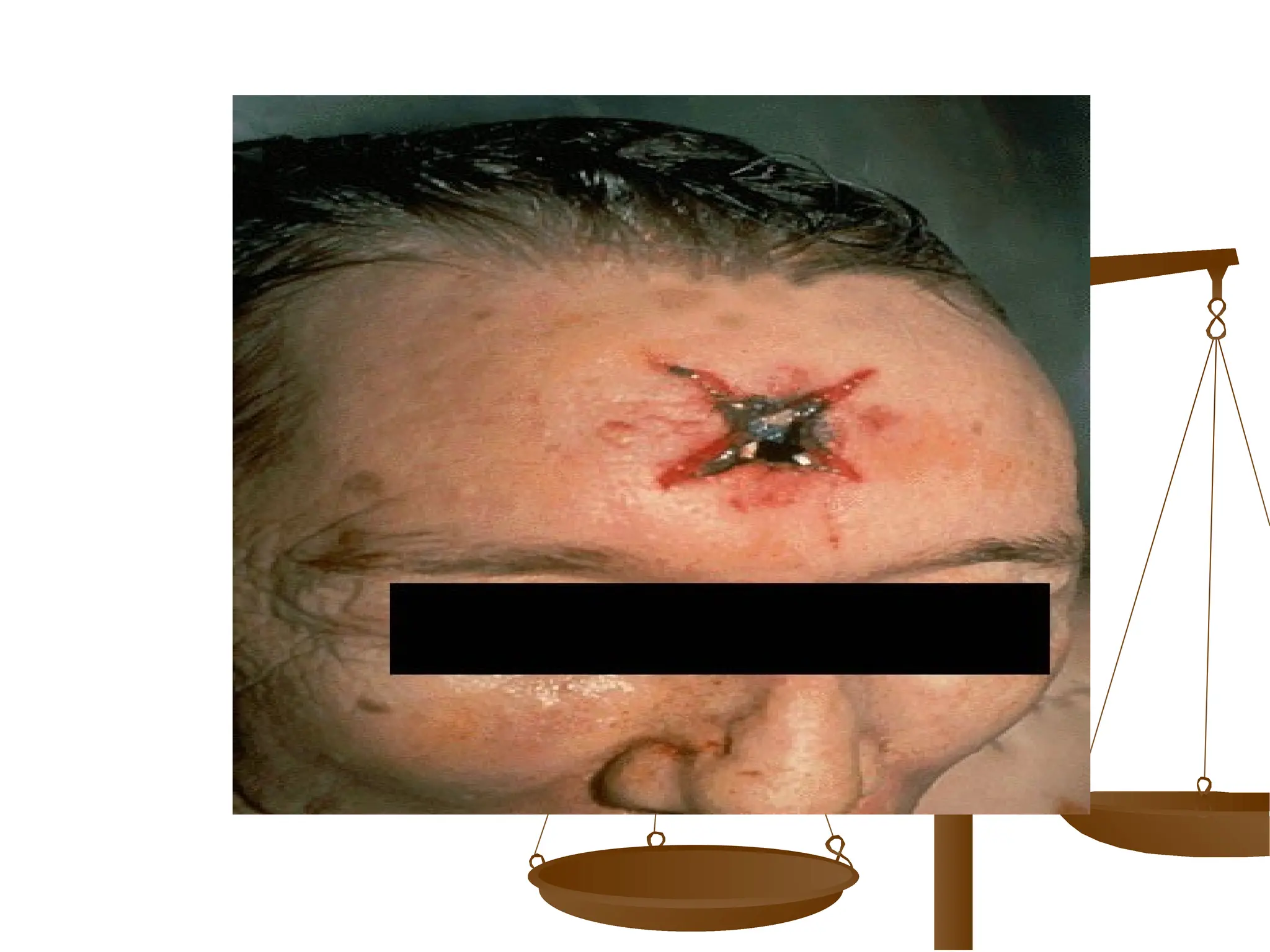 9CHARACTERS OF FIRE ARM INJURIES (WOUND).pptx