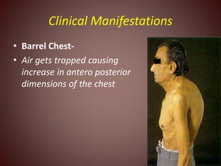 Barrel Chest Copd