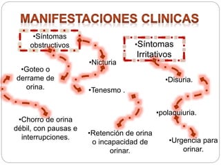 Hiperplasia prostatica | PPTX