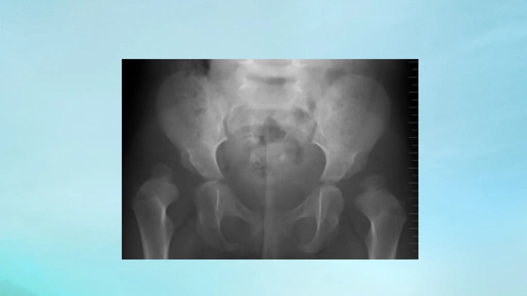 DDH developmental dysplasia of hip .pptx