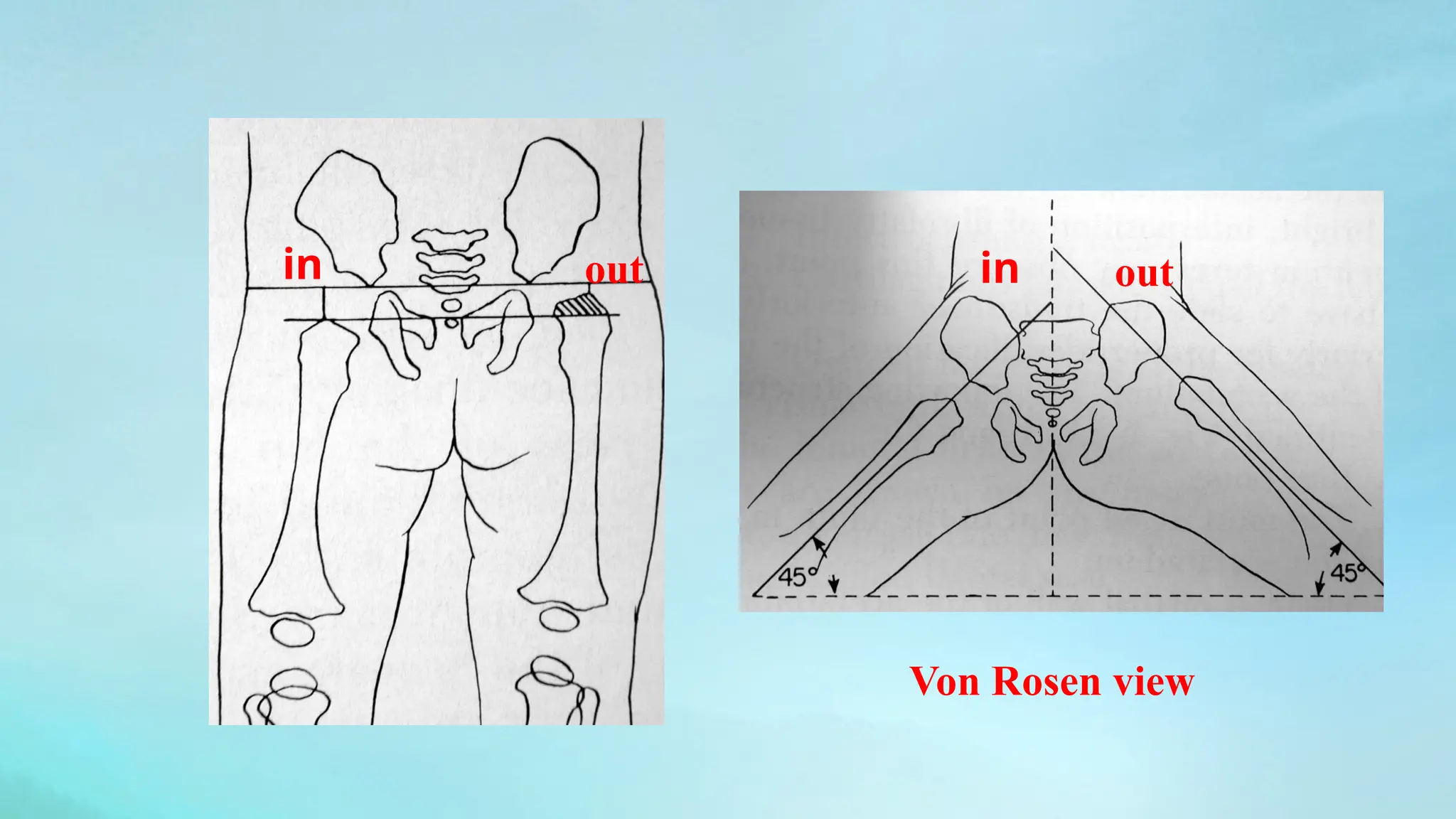 DDH developmental dysplasia of hip .pptx