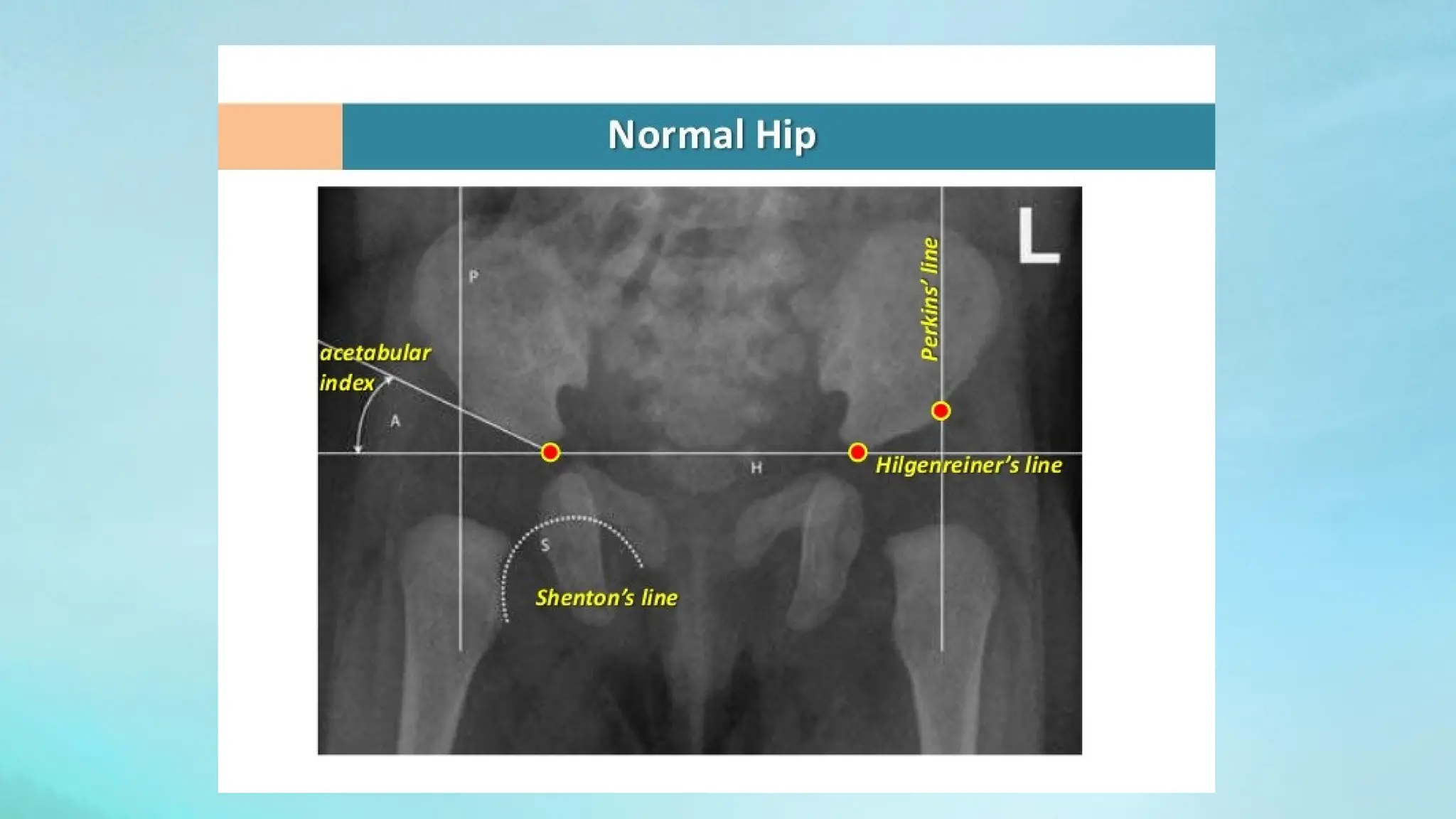 DDH developmental dysplasia of hip .pptx