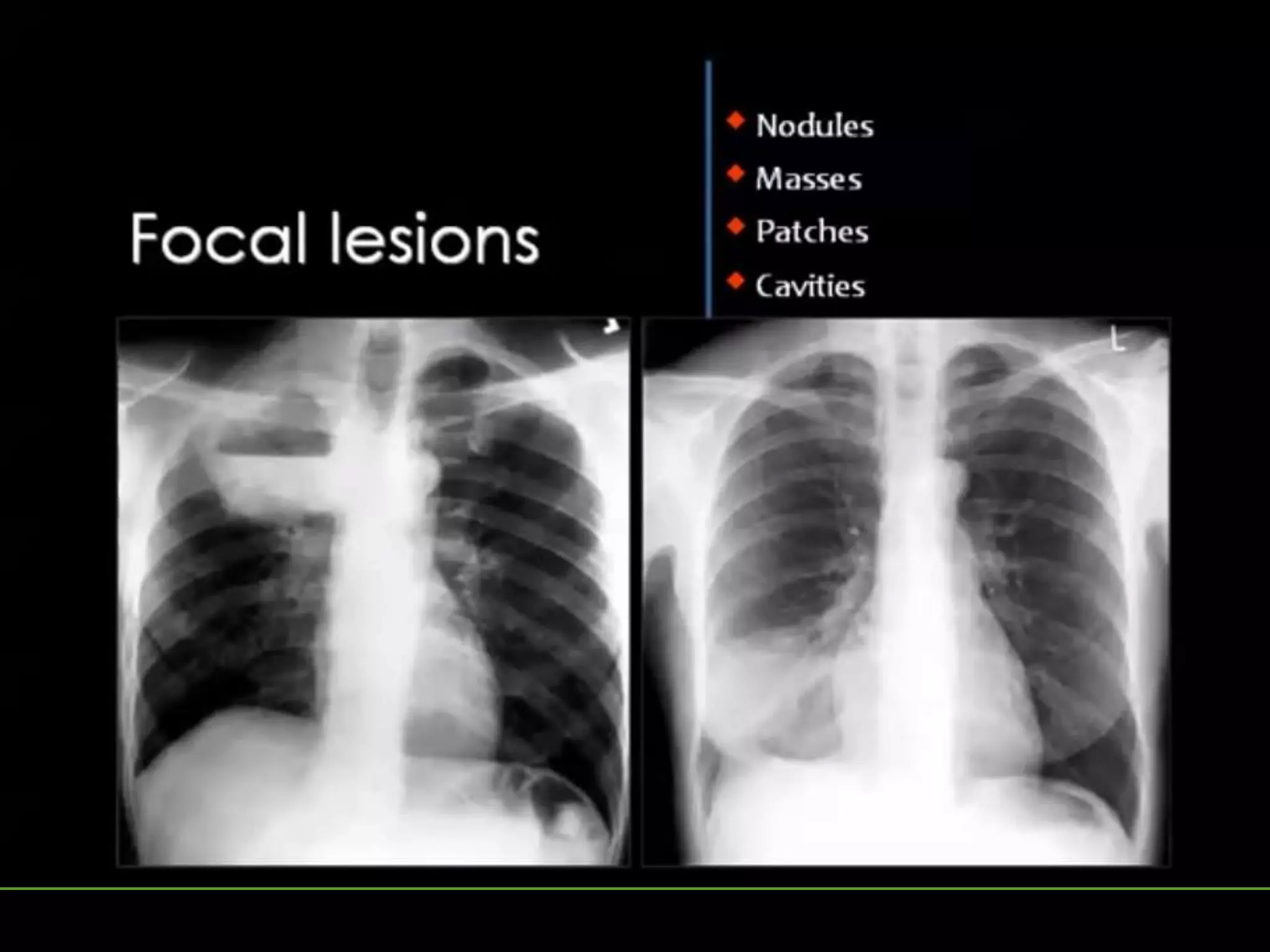 Imaging of Focal Lung Lesions | PPTX