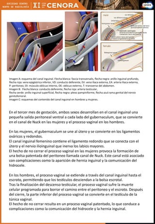 Anatomía quirúrgica del canal inguinal pdf | PDF