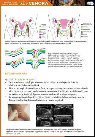 Anatomía quirúrgica del canal inguinal pdf | PDF