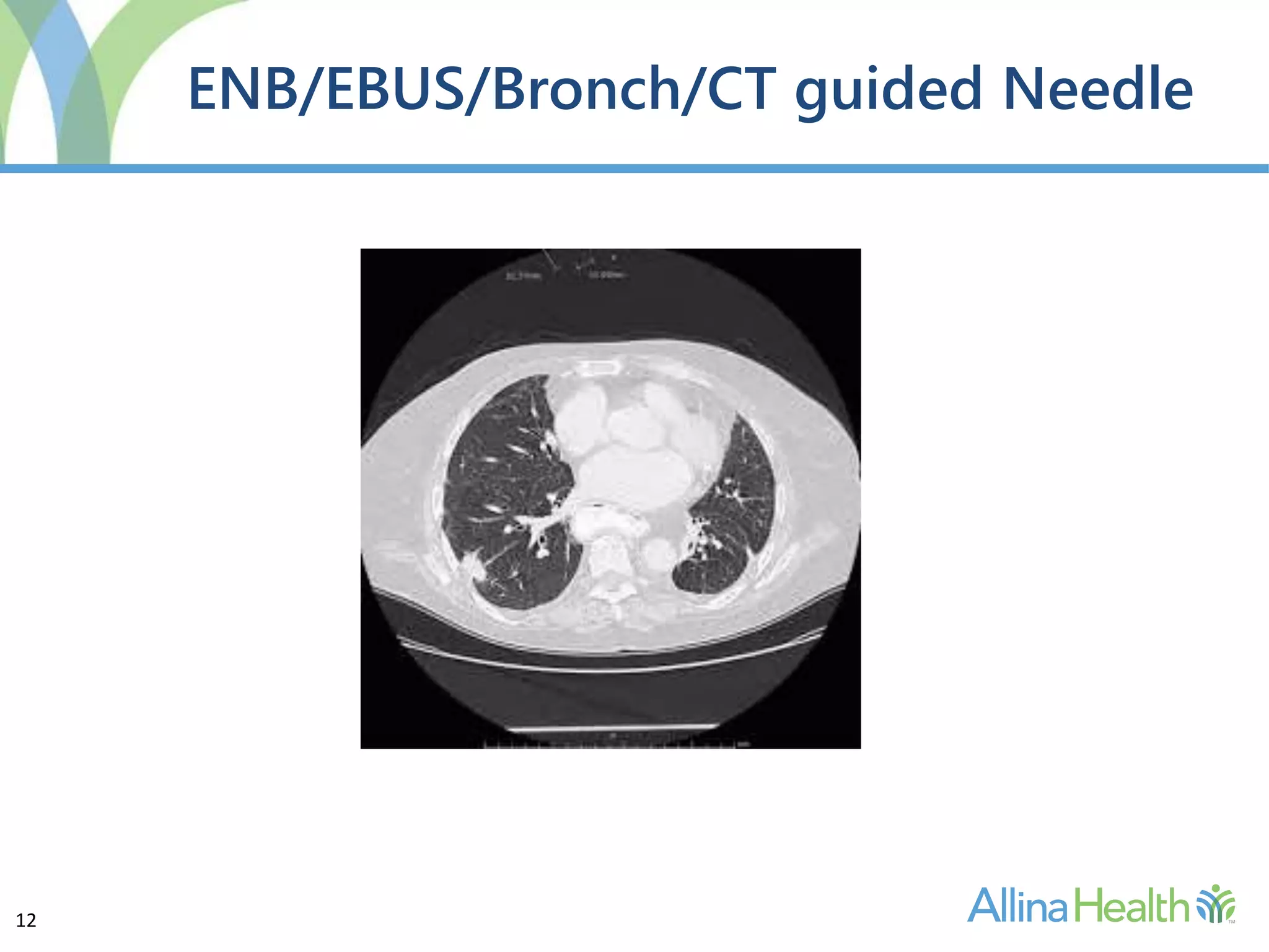 Electronavigation Bronchoscopy | PPTX | Lung and Respiratory Health ...