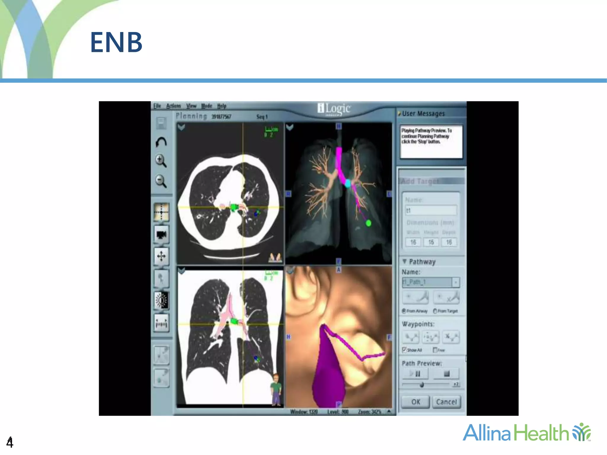 Electronavigation Bronchoscopy | PPTX | Lung and Respiratory Health ...