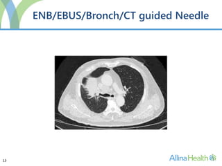 Electronavigation Bronchoscopy | PPTX | Lung and Respiratory Health ...