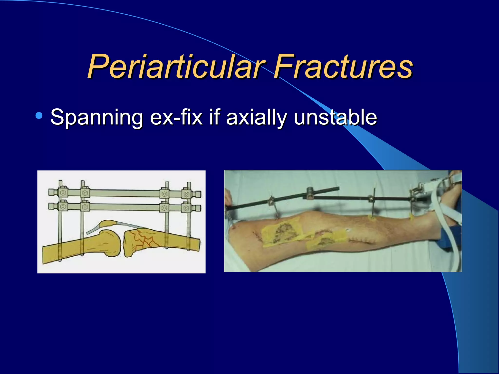 (9)external fixation indications and techniques(bonatus) | PPT