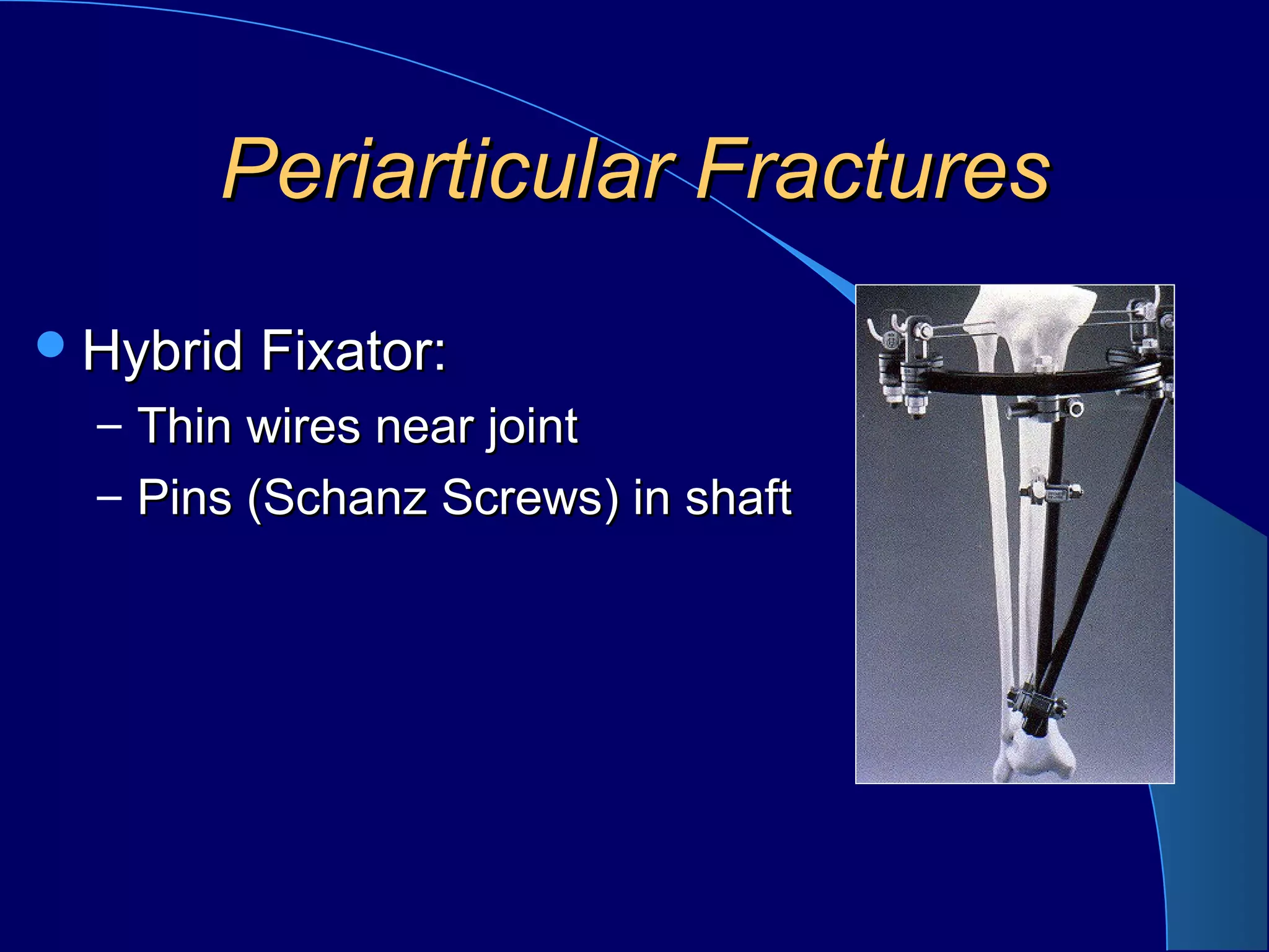 (9)external fixation indications and techniques(bonatus) | PPT