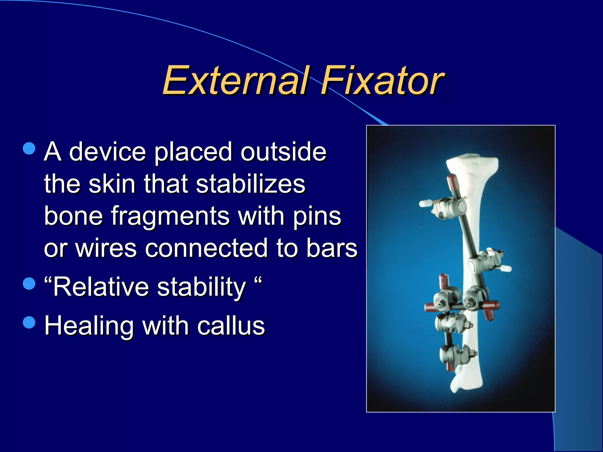 (9)external fixation indications and techniques(bonatus) | PPT