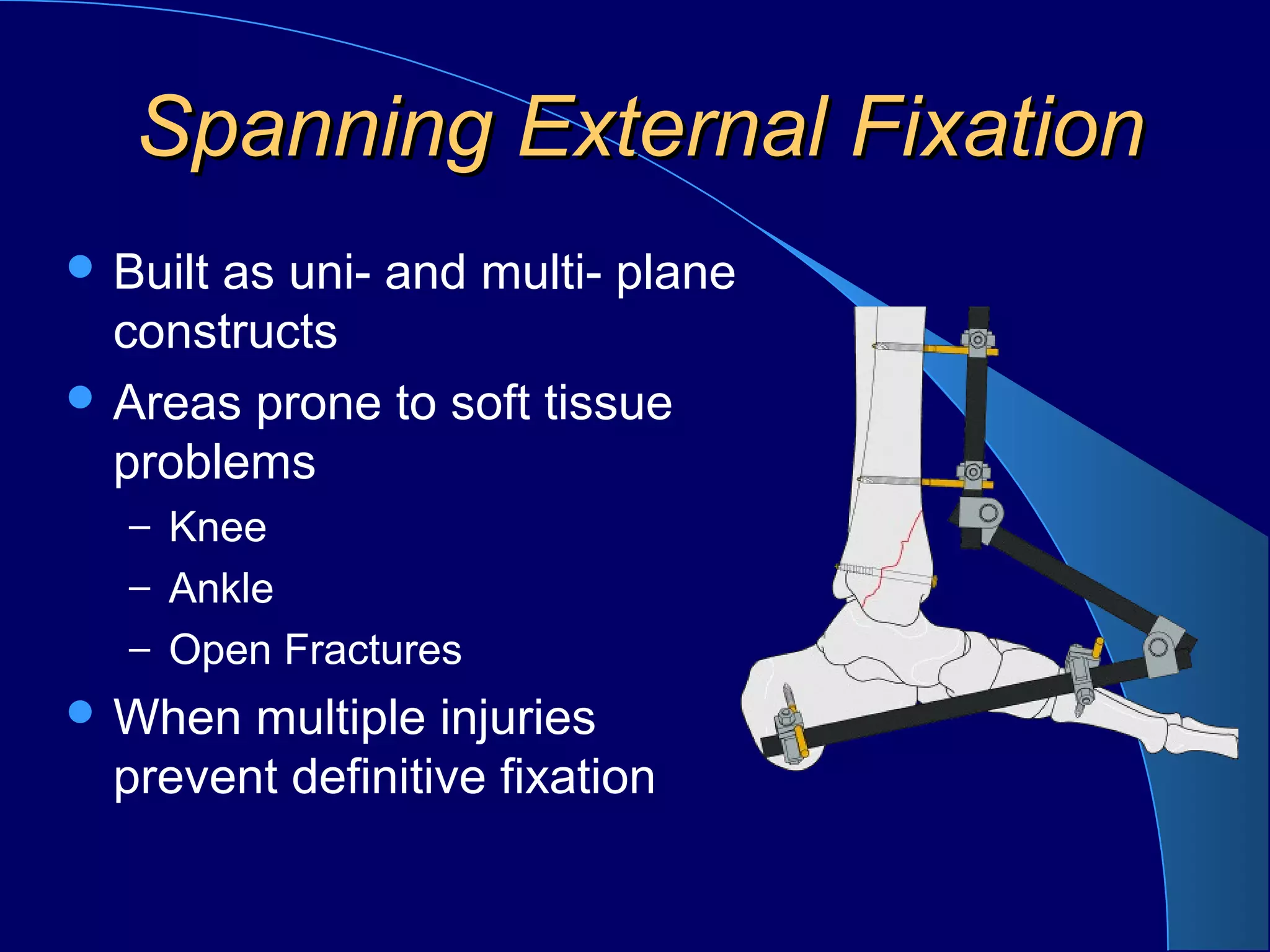 (9)external fixation indications and techniques(bonatus) | PPT