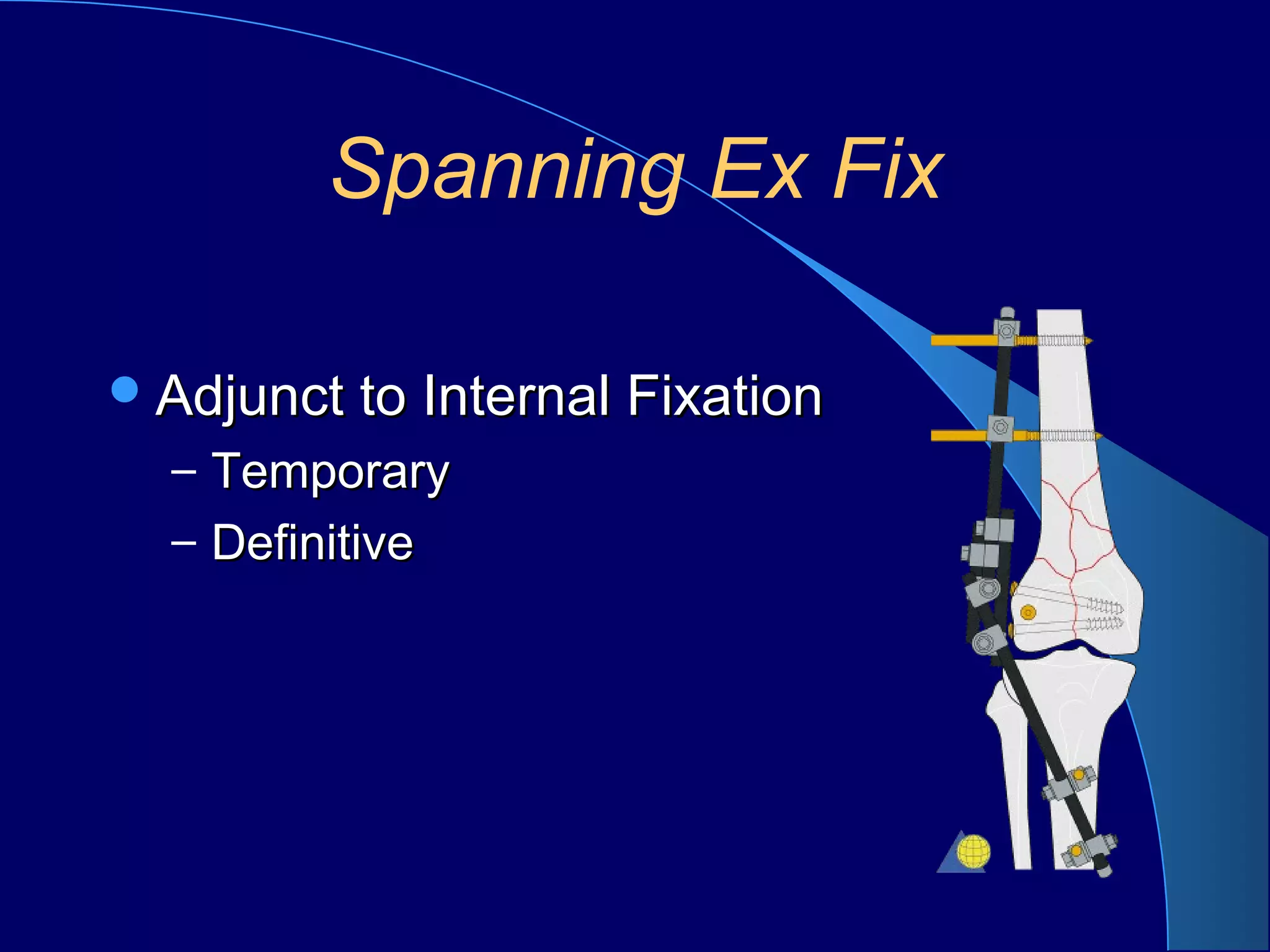 (9)external fixation indications and techniques(bonatus) | PPT