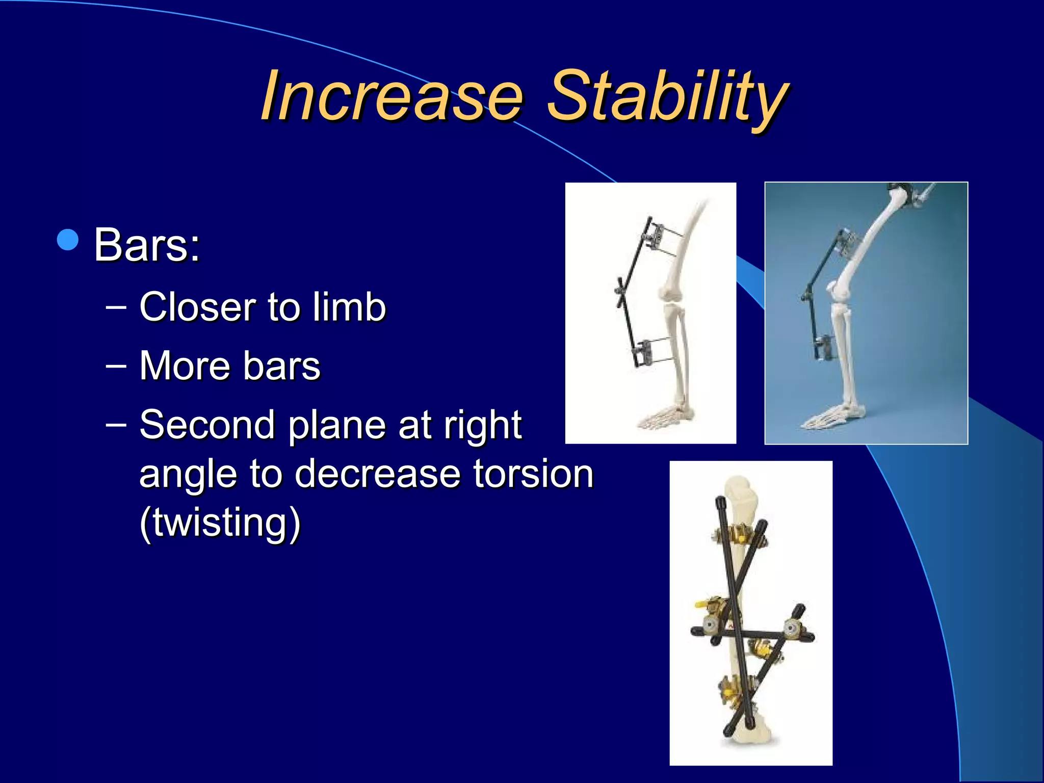 (9)external fixation indications and techniques(bonatus) | PPT