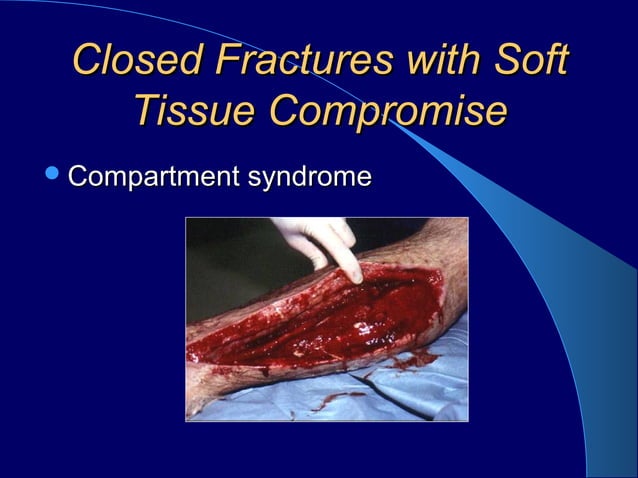 (9)external fixation indications and techniques(bonatus) | PPT | First ...